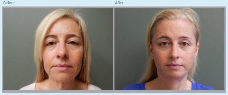Facelift Orlando, FL | Orange County Rhytidectomy